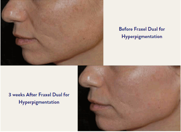 Fraxel Dual Laser Skincare NYC - Goldenberg Dermatology