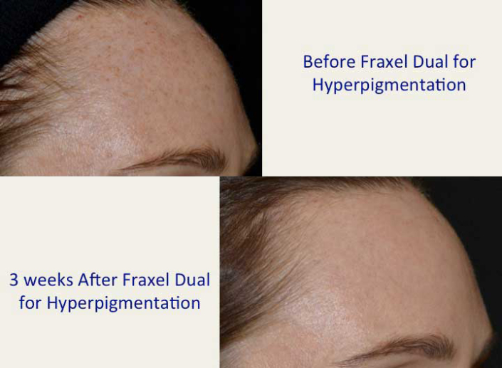 Fraxel Dual Laser Skincare NYC - Goldenberg Dermatology