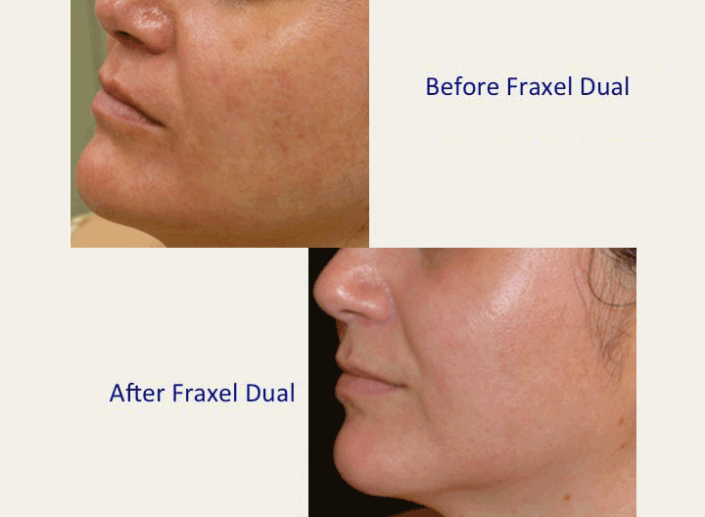 Fraxel Dual Laser Skincare NYC - Goldenberg Dermatology